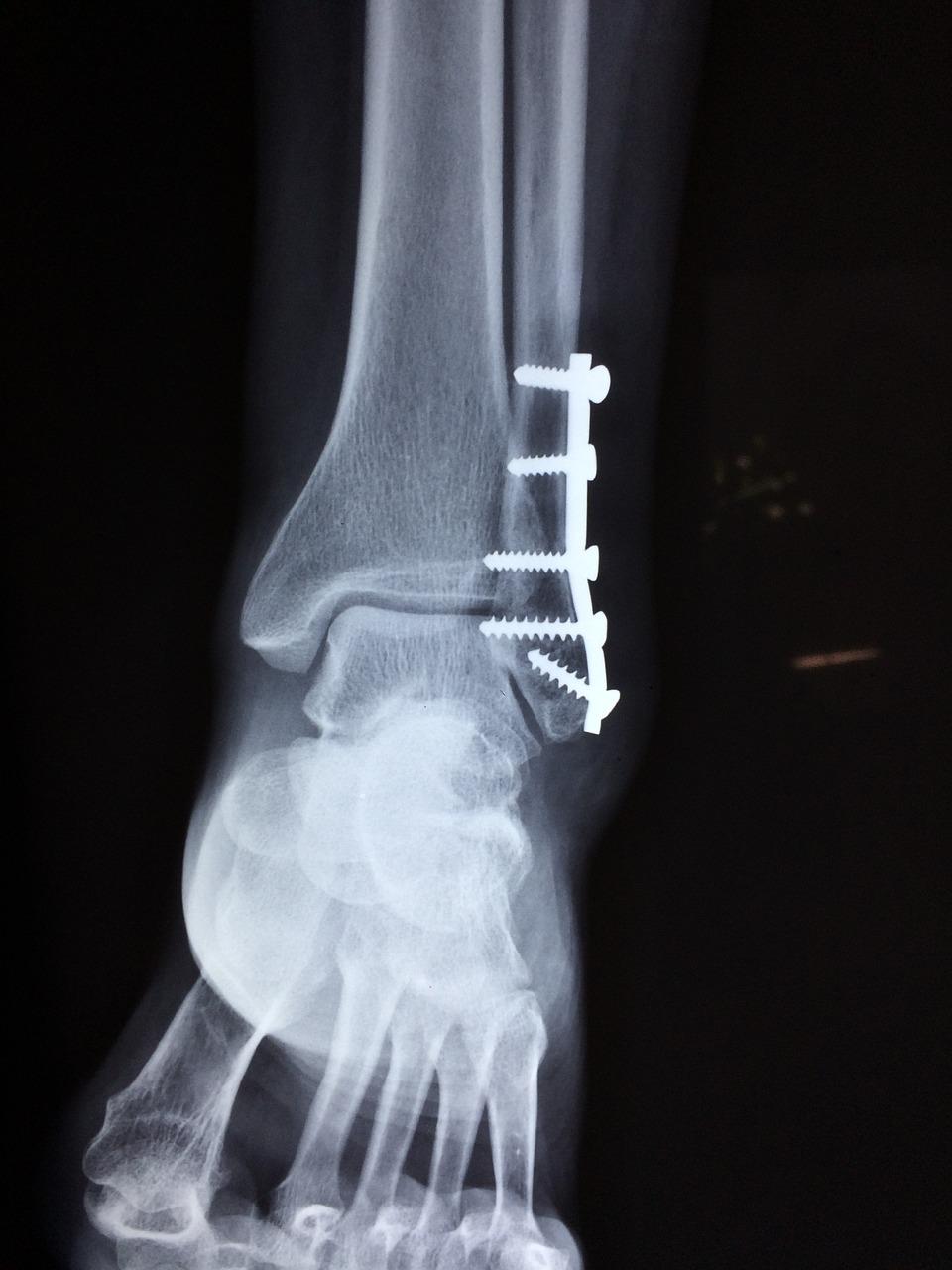 Fractura de gleznă - simptome, diagnostic, tratament, perioada de ...