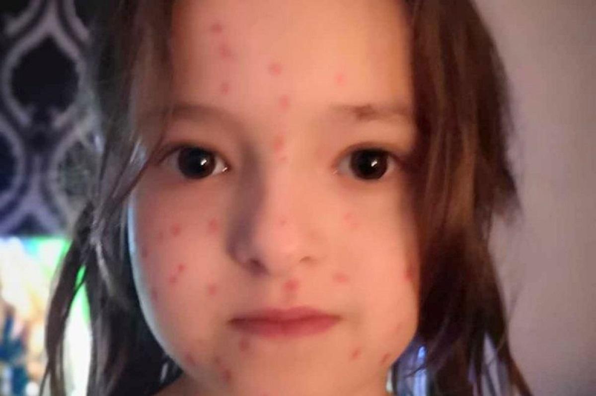 Fetiţă îşi Desenează Bube Pe Faţă Ca Să Evite Un Test La şcoală